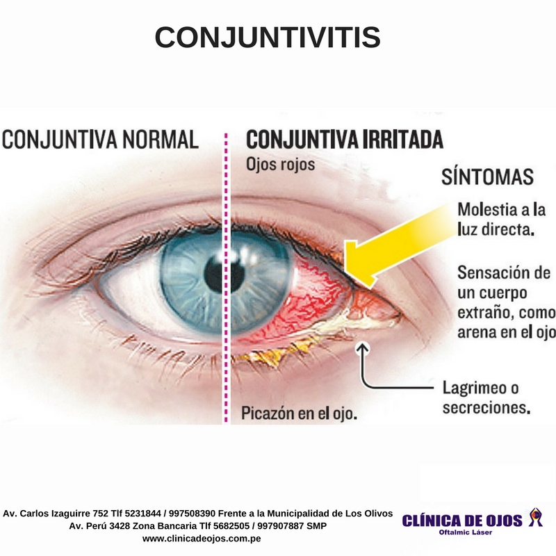 Clínica de Ojos Oftalmic Láser: CONJUNTIVITIS