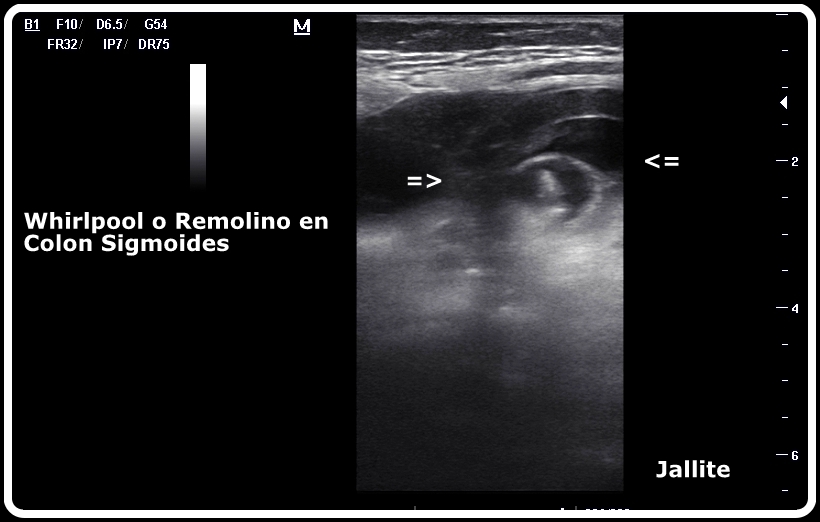 Signo del Whirlpool o del Remolino