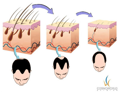 Cosmoworld Clinics: ALL ABOUT RECEDING HAIRLINE