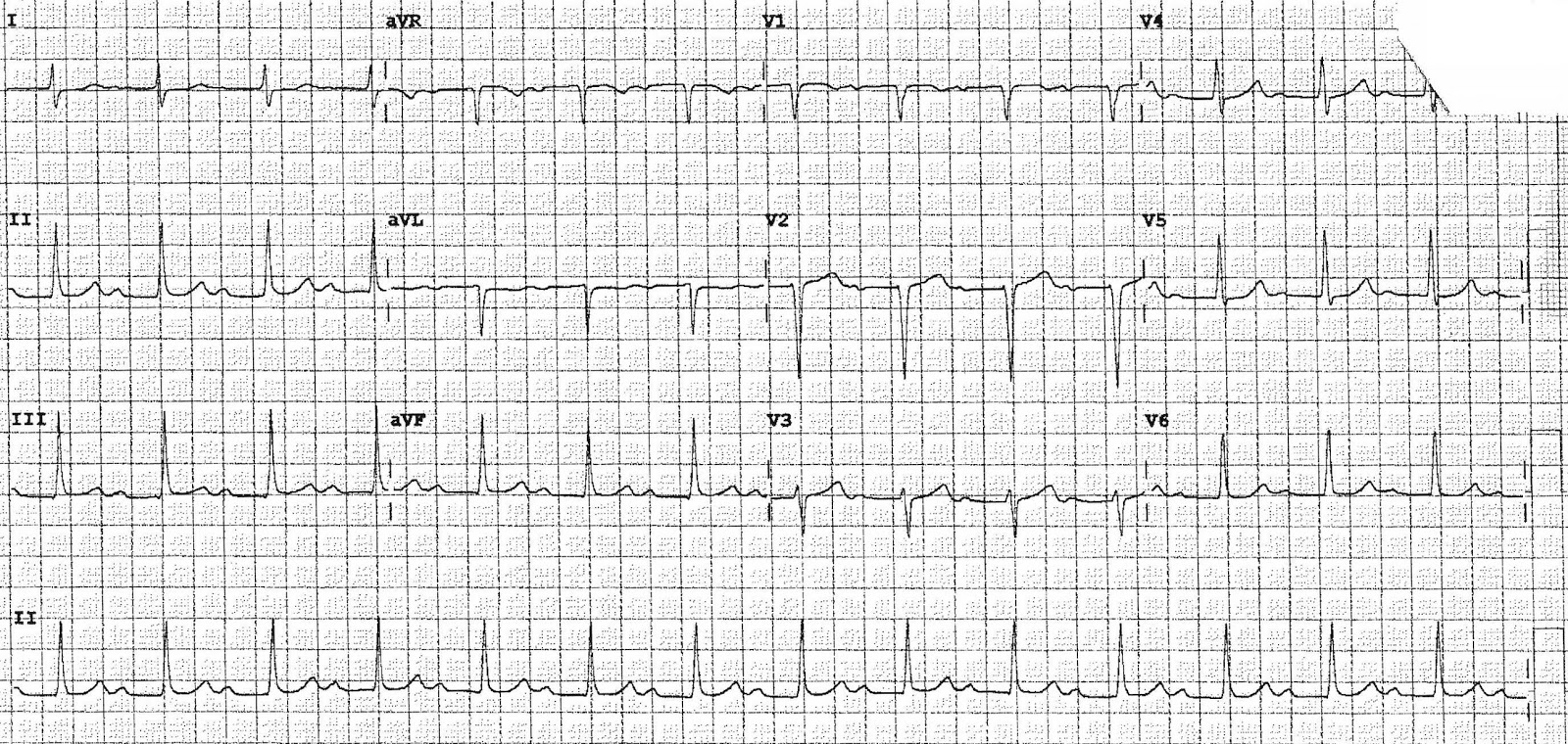 ECG of the Week: ECG of the Week - 5th December 2016 - Interpretation