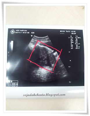 Di sini hatiku berlabuh~: Tanda-tanda Cyst