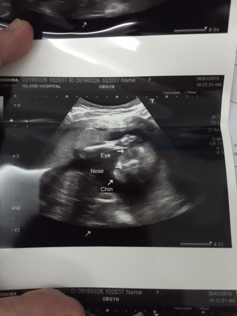 Independent Me !!!: Pregnancy Diary : 22 Weeks Check up and Anomaly Scan