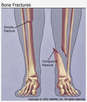 Rumah Terapi “PERMATA HOLISTIC”: PATAH TULANG