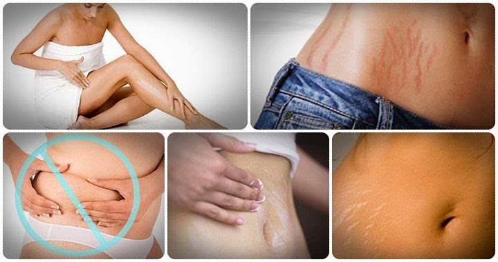 Ways To Get Rid Of Stretch Marks Medi Craze