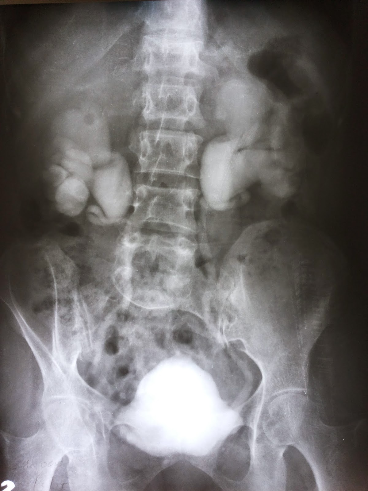 Varun's Radiology Blog: Pine Cone Appearance in Neurogenic Bladder