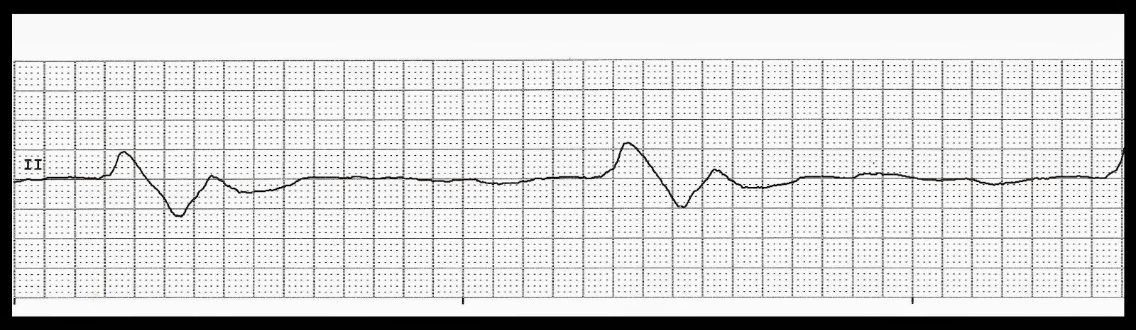 Basic EKG Rhythm Test 17