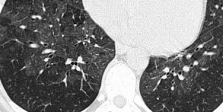 Chest Medicine Made Easy-Dr Deepu: BASICS OF HRCT PART-4 , HIGH ATTENUATION PATTERN