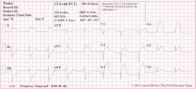 ECG Educator Blog : 07/31/16