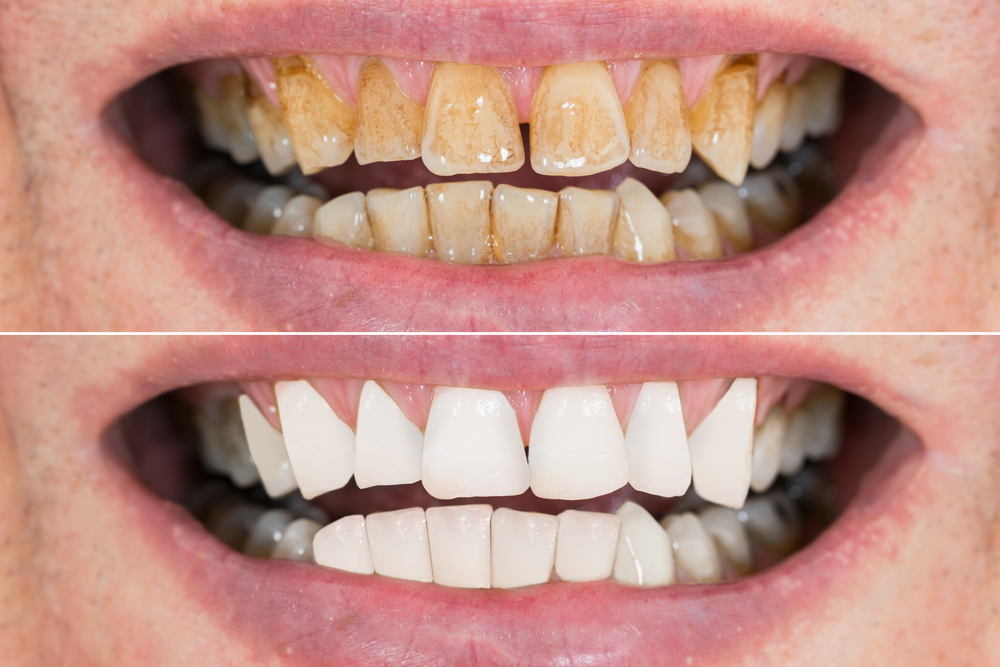 Teeth Discoloration Causes Symptoms Prevention And Cures