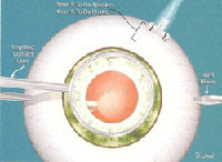 My OpToMeTRy JouRNey: PeNgaLaMaN PeRTaMa Di DaLaM BiLiK PeMBeDaHaN Mata