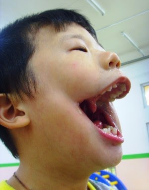 Transverse Facial Cleft