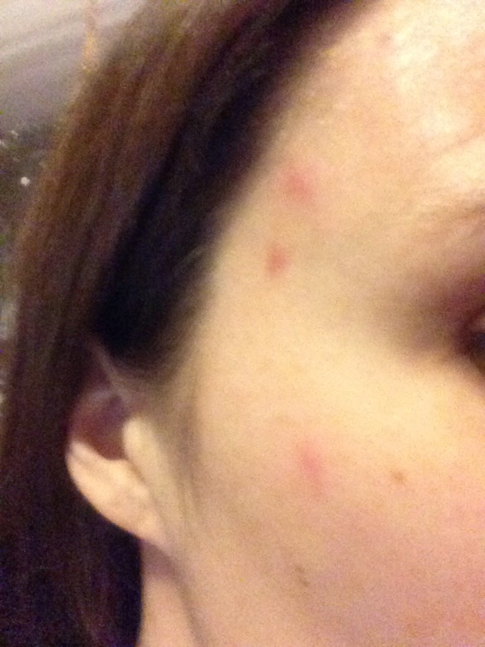 The Clean Reality: Demodex Mites and the all natural fix...