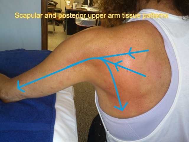Posterolateral Scapular Treatment Patterns | Modern Manual Therapy Blog ...