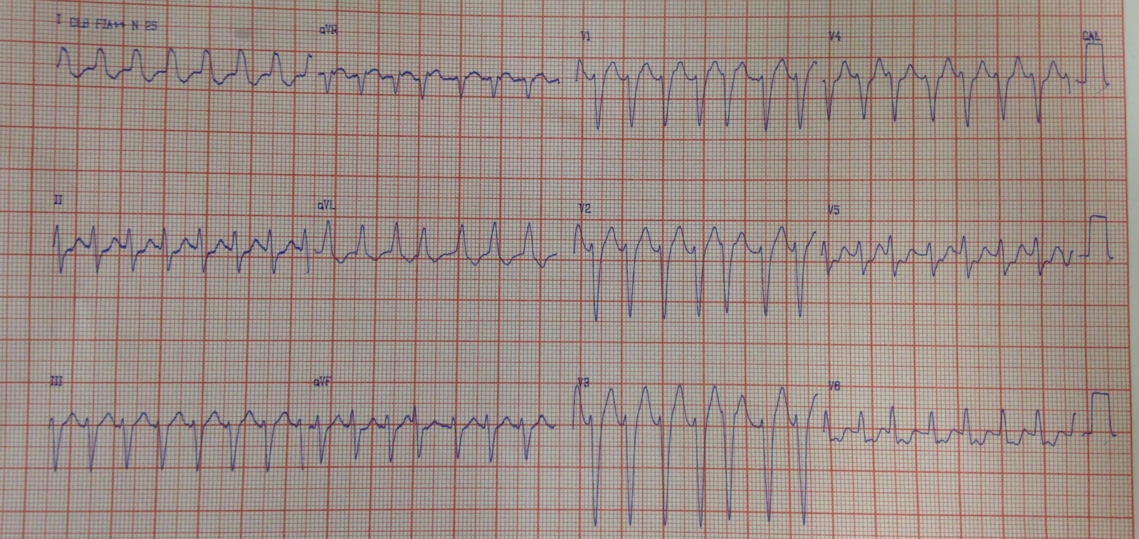 Temas em Cardiologia: Novo critério eletrocardiográfico para ...