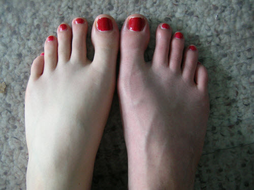 Struggling With Postural Tachycardia Syndrome (POTS): Summertime With ...