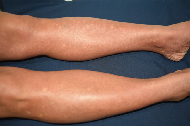 VIRTUAL GRAND ROUNDS IN DERMATOLOGY 2.0: A Woman with Fever, Malaise ...