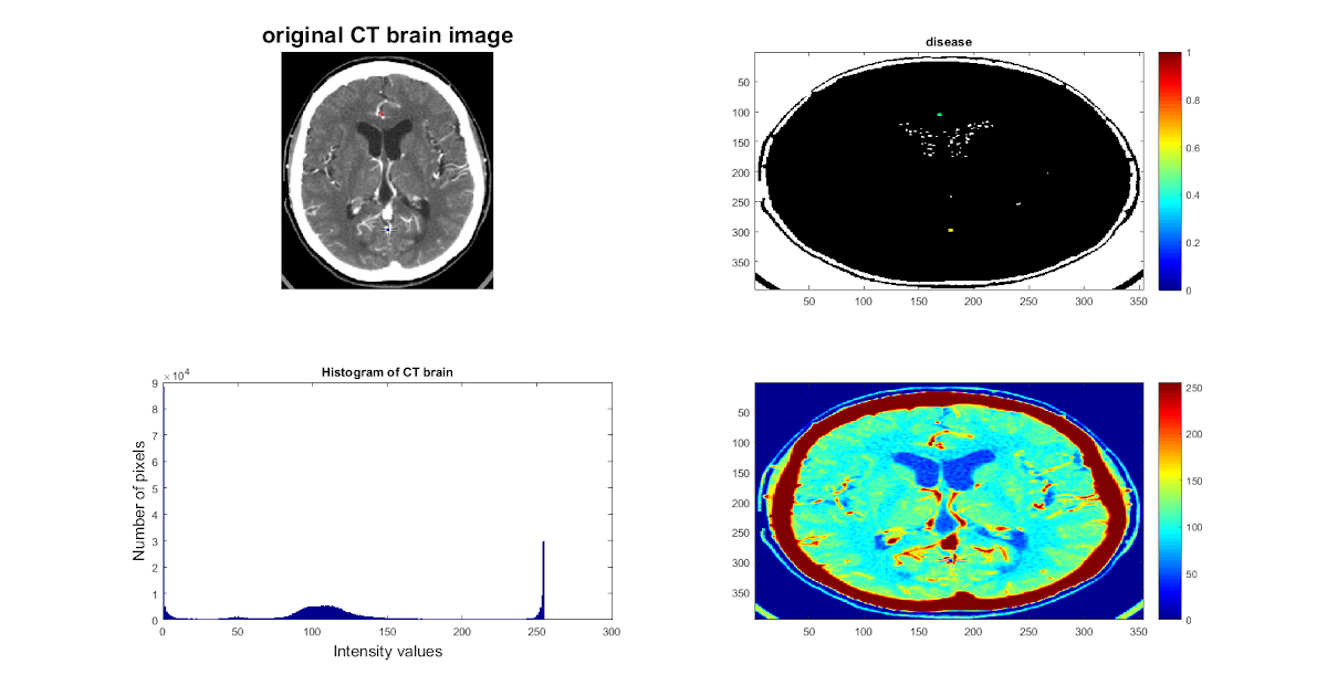 Biomedical Signal and Image Processing projects using Matlab and Labview tools: CT scan of brain ...