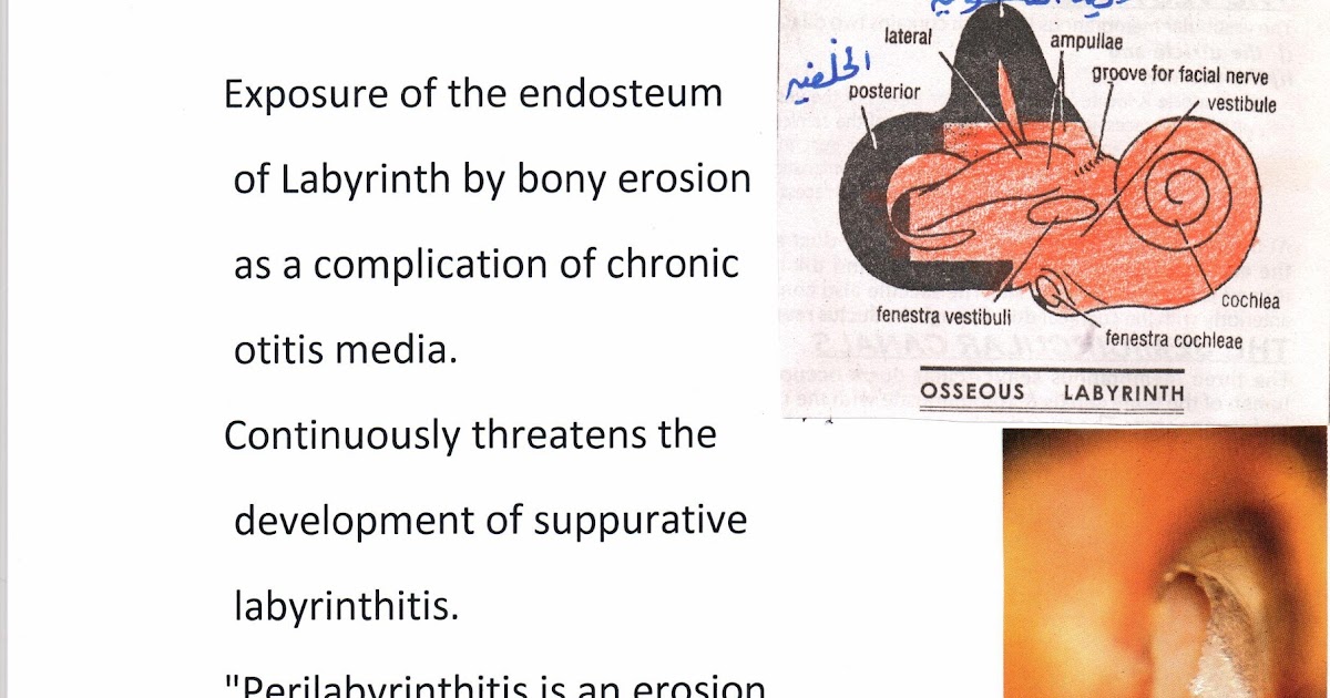 المدونة الطبية د.فهيد سالم السبيعي: LABYRINTHINE FISTULA