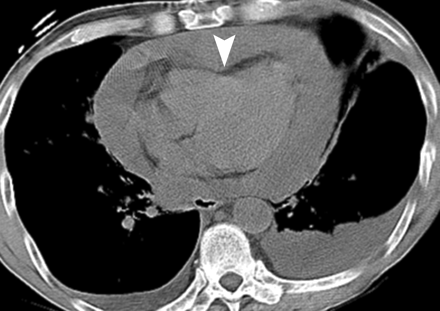 Random blah de blah: Cardiac Tamponade with a focus on medical imaging