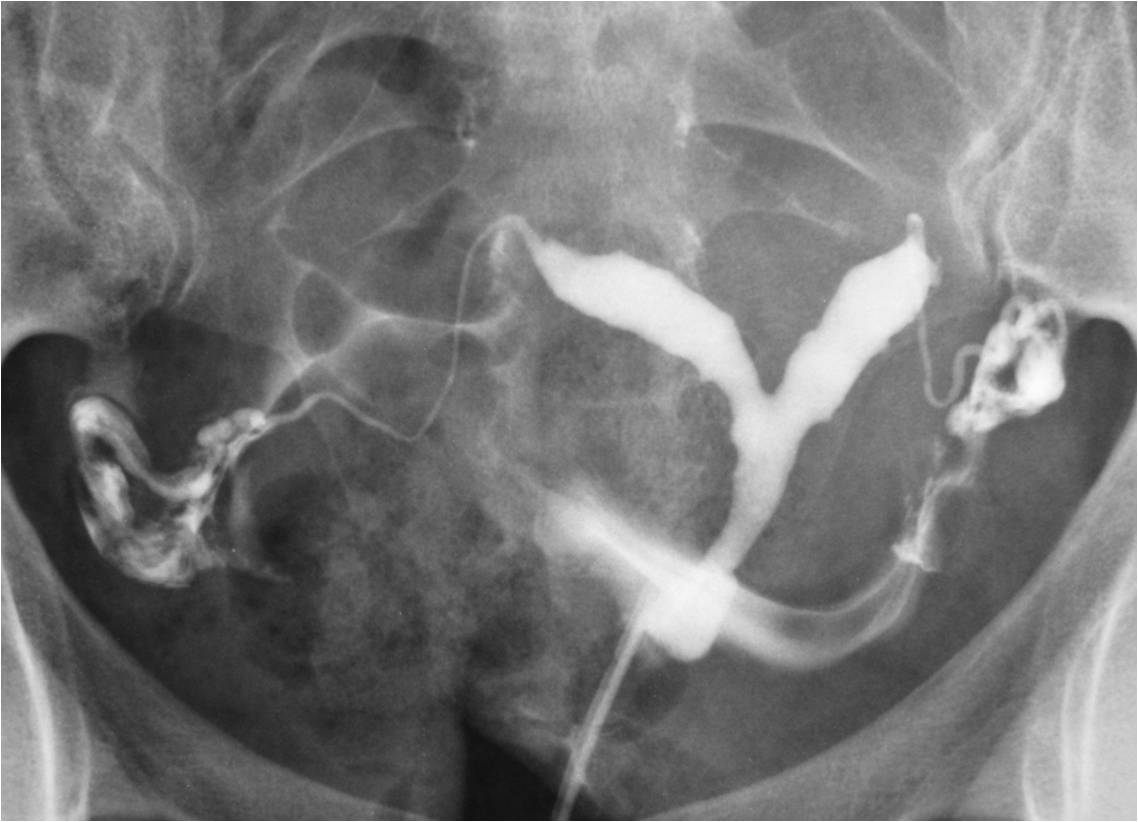 Luciana Chamié: Útero septado ou bicorno? Como investigar as ...