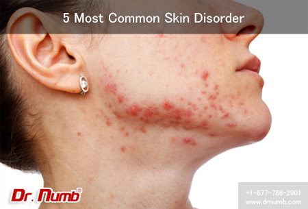 Natural Blessings: 5 Most Common Skin Disorder