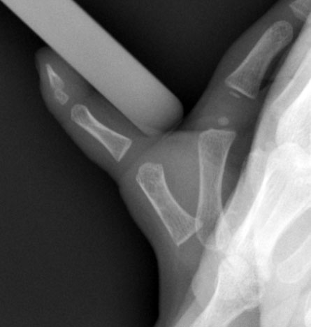 The Crooked Thumb | Congenital Hand and Arm Differences | Washington ...