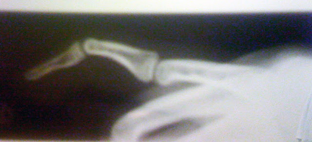 Desh Raj Sonyok: Recovery of My Mallet Finger Injury in Judo Training