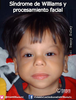 Síndrome de Williams y procesamiento facial | Nosotros viviendo con ...