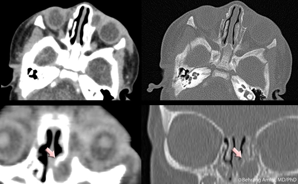 Roentgen Ray Reader: Nasolacrimal Duct Dacrocystocele