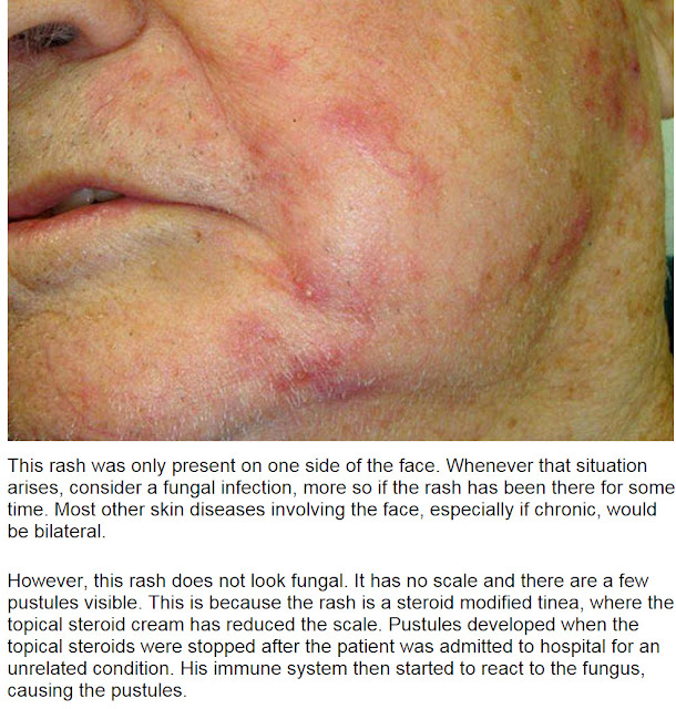 Consultations in Dermatology: Tinea incognito face