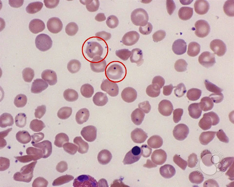Alterações eritrocitárias encontradas em pessoas sem baço | Biomedicina ...
