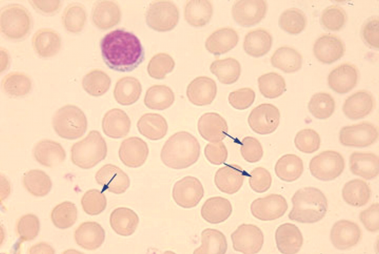 Hereditary spherocytosis - Genetic diseases Membrane Blood Cells Red ...