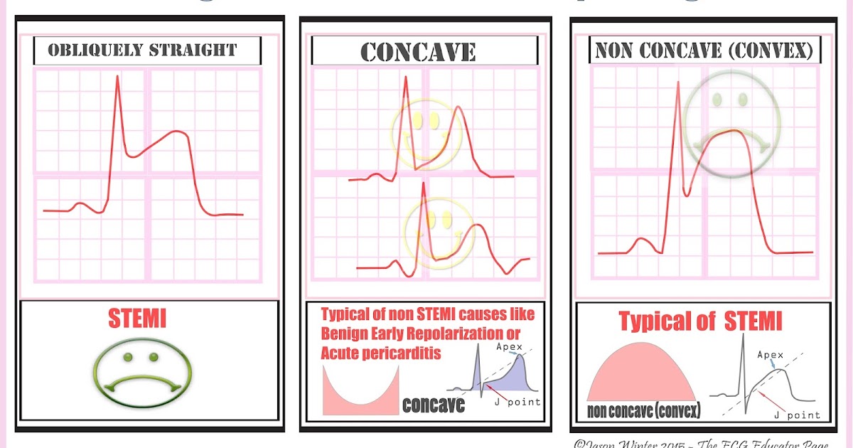 ECG Educator Blog : ST Segment Elevation Morphologies