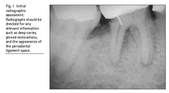 Endodontic: In irreversible pulpitis