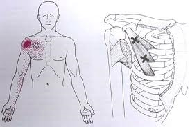 Why Pec Minor can be a major pain - MobilizeMe Physiotherapy