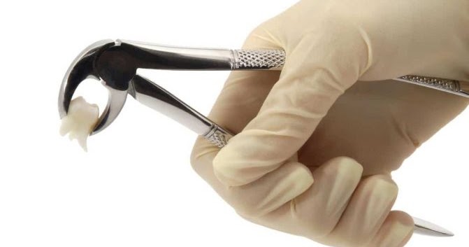 Blog. Just Blog: Ce implică extracția unui molar de minte?