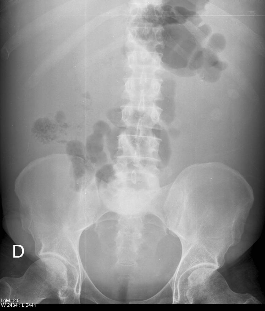 Claves de Salud: Síntomas de la Apendicitis