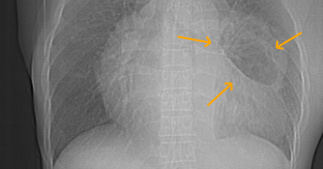 Pneumopericardium: CXR - Sumer's Radiology Blog