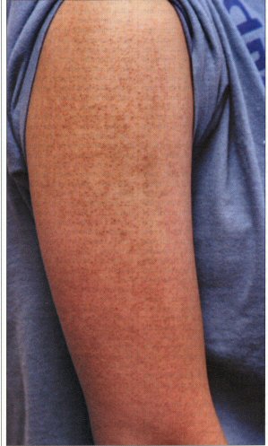 Beauty tips from an Asian: Keratosis Pilaris Problem.