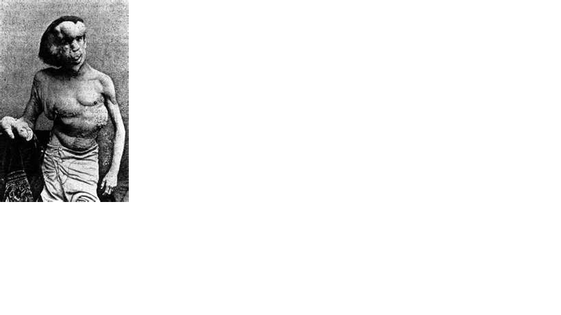 World's Tragic In Medlife,.....You May Know Or Not: Proteus syndrome