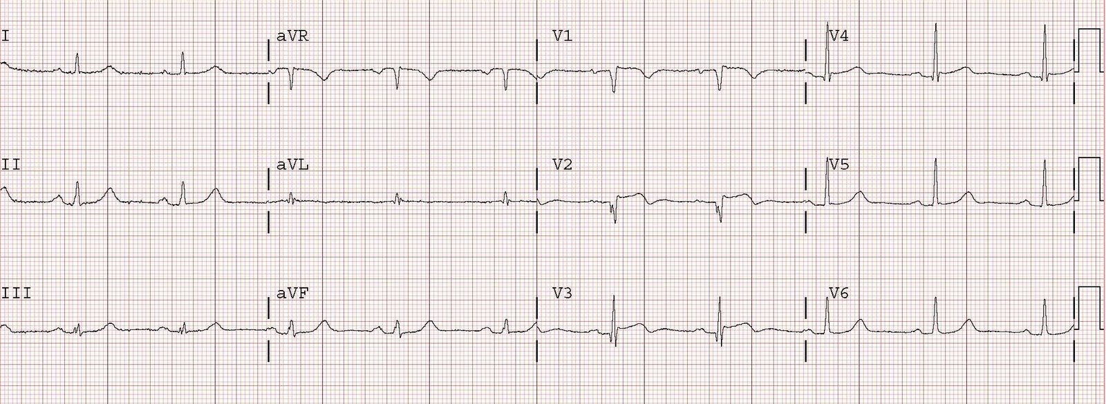 Dr. Smith's ECG Blog: Anterior MI: Ongoing STEMI, reperfused STEMI, or ...
