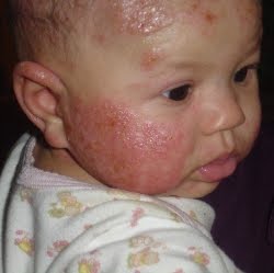 Baby Rash on Face, Cheeks and Neck - Please Doctor