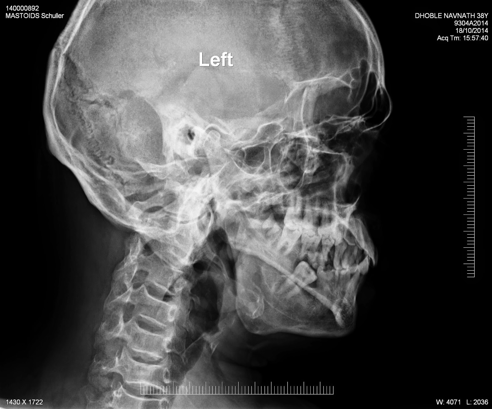 Ear Infection X Ray at Bernardo Johnson blog