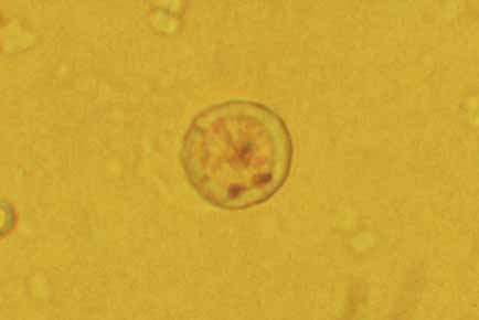 [Haematology] Microscopic Examination of Urinary Sediment - Crystals ...