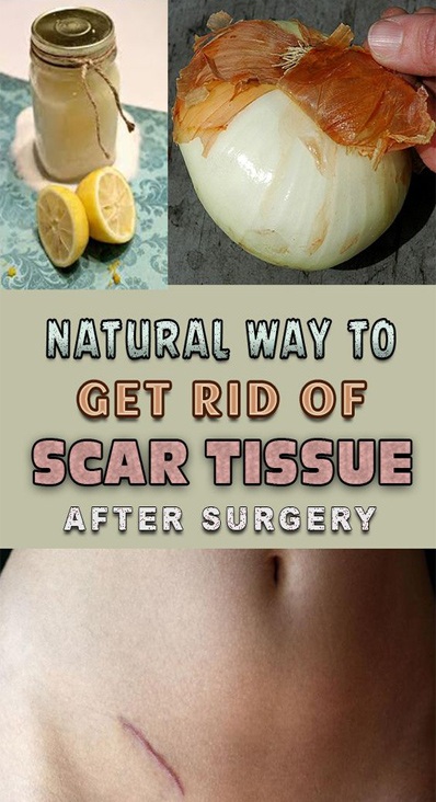 LIFE AT FIT : Natural Way to Get Rid of Scar Tissue After Surgery
