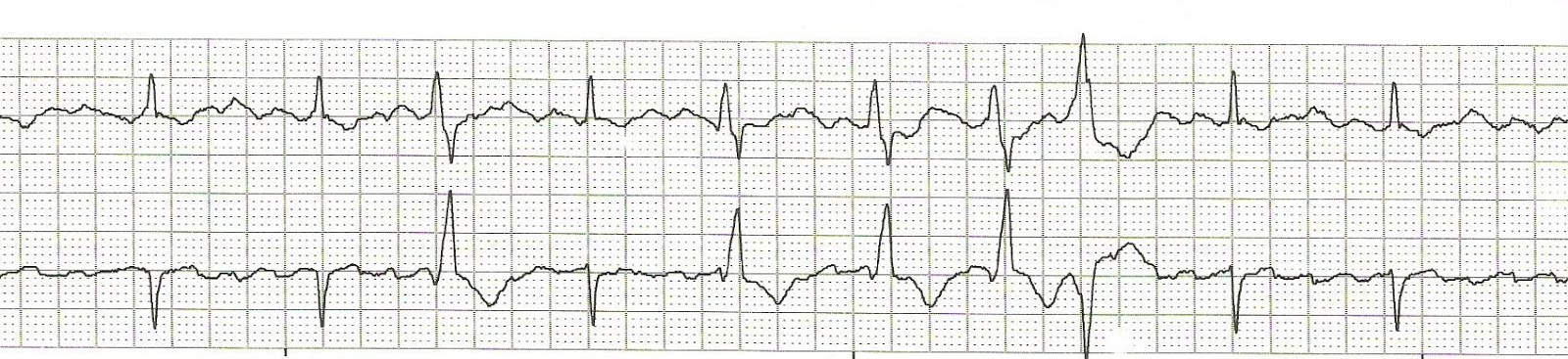 EKG Rhythm Strip Quiz 62