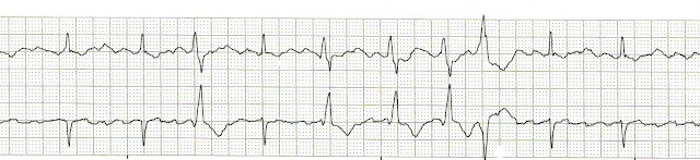 EKG Rhythm Strip Quiz 62