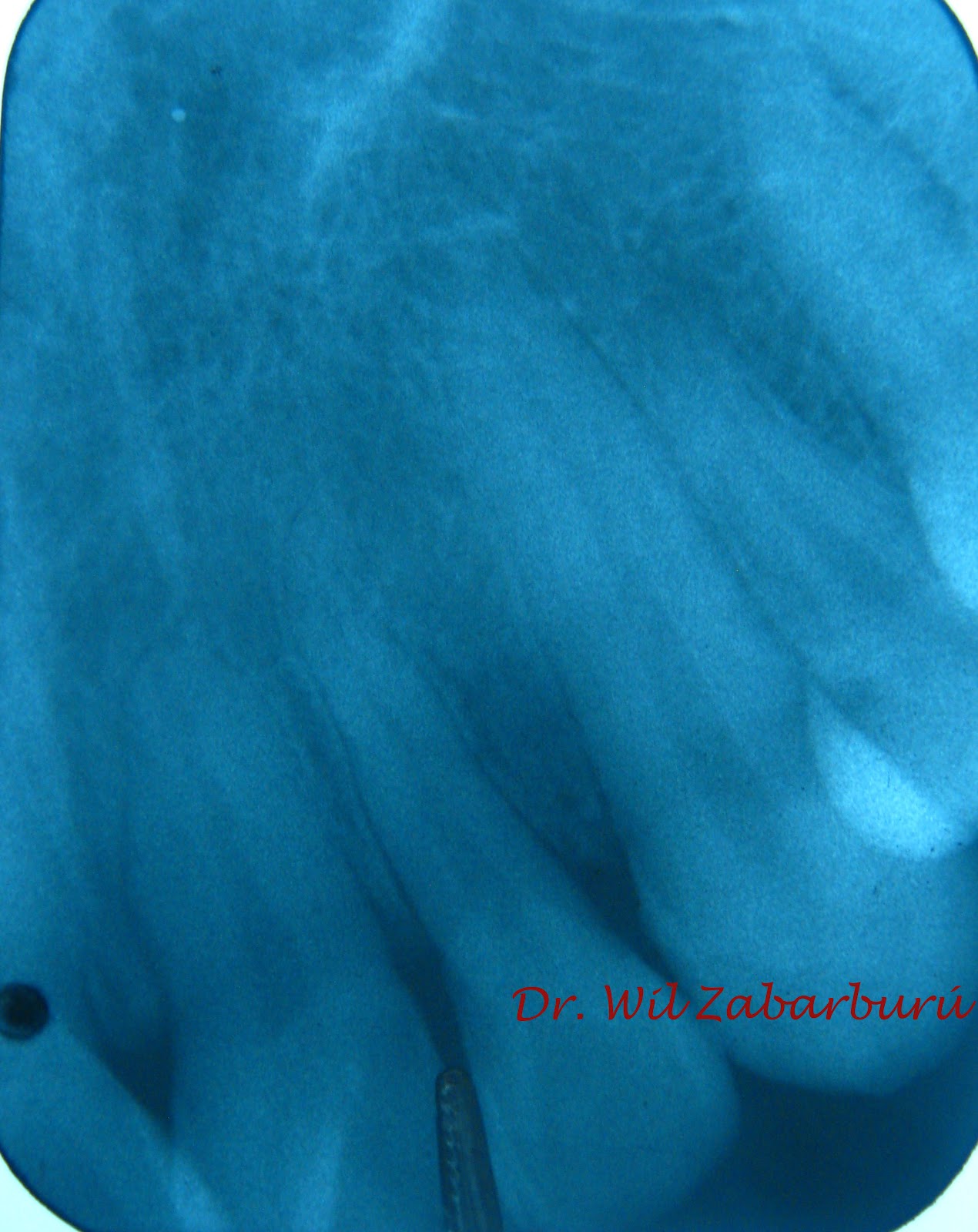 CLINICA DENTAL ASISTENCIAL: GRANULOMA PIÓGENO CLINICA DENTAL ASISTENCIAL: GRANULOMA PIÓGENO