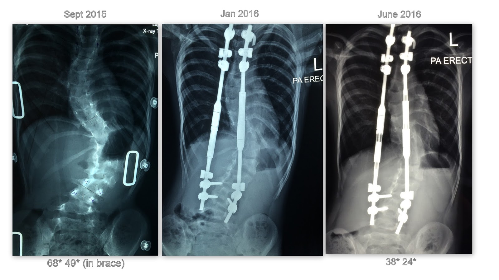 Life with Beals: A year on with MAGEC rods - A 'work in progress'