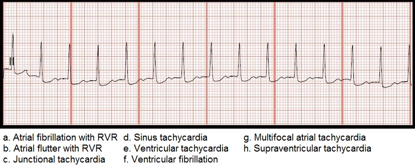 Fast Heart Rhythm Quiz 295